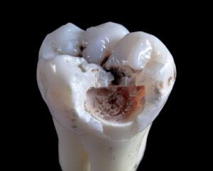 Prosedur Cabut Gigi Geraham, Biaya dan Manfaat Cabut Gigi Geraham – Klinik Gigi SATU Dental