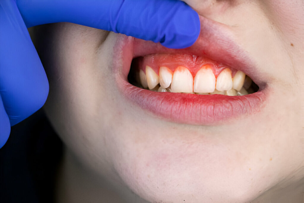 Perawatan Gusi – Klinik Gigi SATU Dental – Klinik Gigi SATU Dental