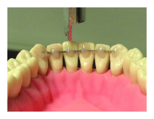 Splinting Gigi: Manfaat, Jenis, Biaya, Prosedur dan Efek Sampingnya ...