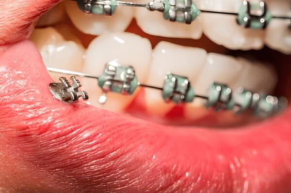 Kelebihan dan Kekurangan Behel Metal serta Harganya - Klinik Gigi SATU ...