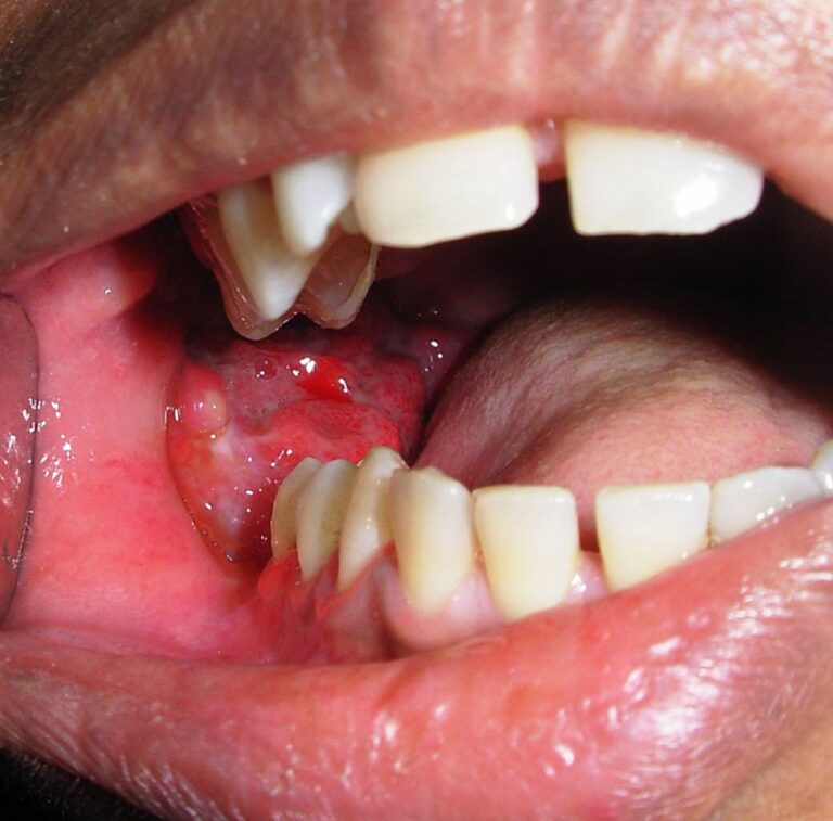 Benjolan di Bibir tapi Tidak Sakit, Apa Penyebabnya? – Klinik Gigi SATU Dental