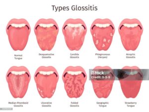 Glositis (Radang Lidah): Definisi, Penyebab, Gejala, dan Penanganannya ...