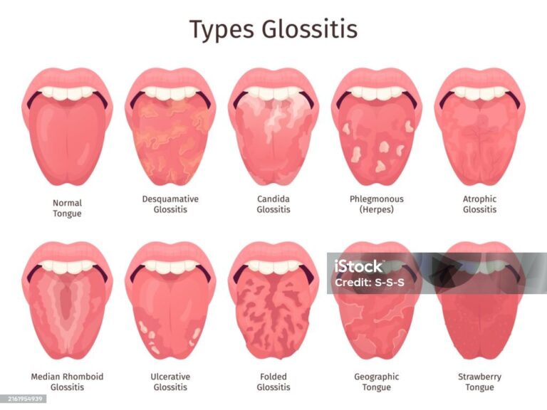 Glositis (Radang Lidah): Definisi, Penyebab, Gejala, dan Penanganannya ...