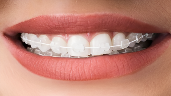 Jenis-Jenis Behel Gigi dan Harganya, Lengkap! – Klinik Gigi SATU Dental
