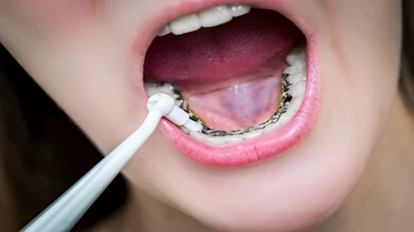Jenis-Jenis Behel Gigi dan Harganya, Lengkap! – Klinik Gigi SATU Dental