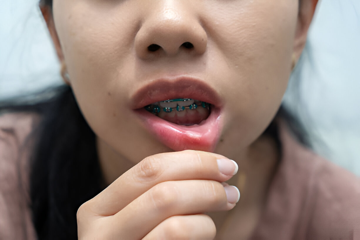 Sariawan saat Puasa? Ini Penyebab dan Cara Mengatasinya - Klinik Gigi SATU Dental