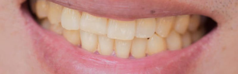 11 Penyebab Gigi Kuning Dan Cara Mengatasinya Dengan Tepat Klinik